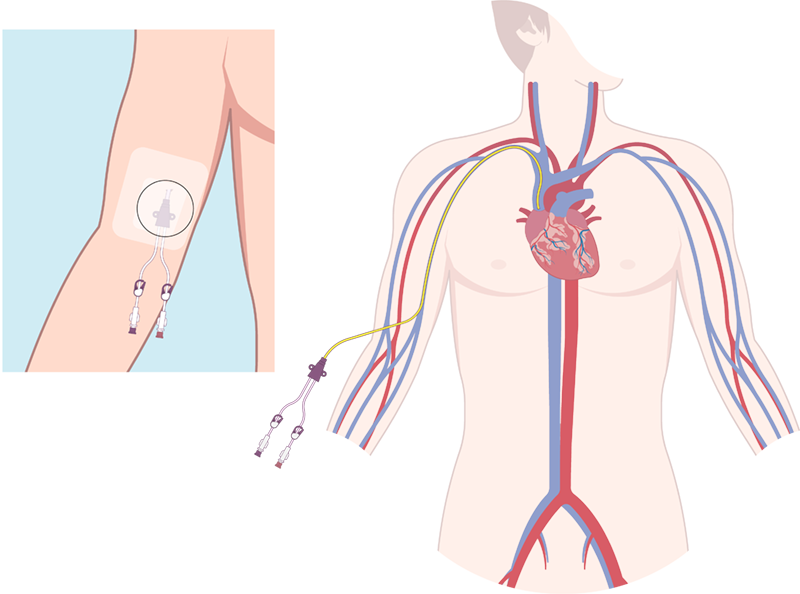 Le PICC Line : une expertise incontournable des technologues en imagerie médicale du CUSM ...